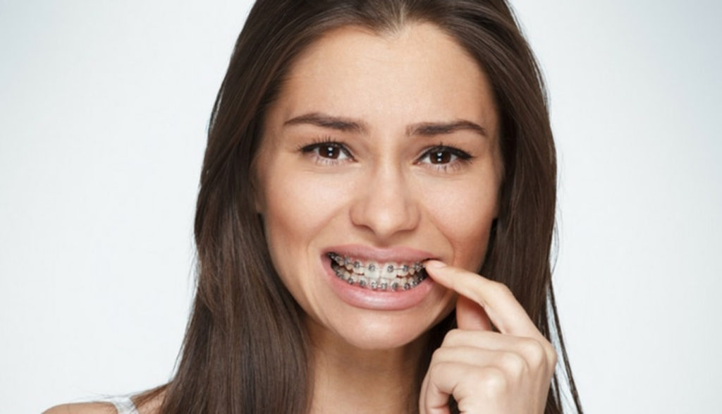 Avoid Bad Breath while wearing Invisalign or Braces